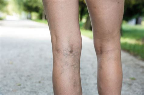 Żylaki przyczyny objawy diagnostyka i leczenie