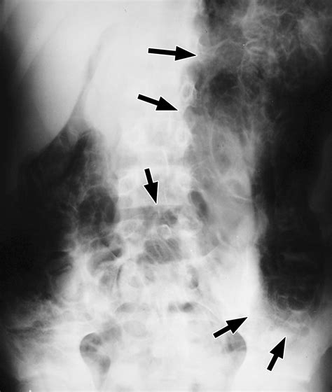Pneumatosis Intestinalis In The Adult Benign To Life Threatening