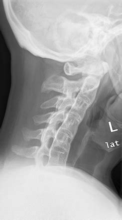 Cervical Ankylosing Spondylitis X Ray