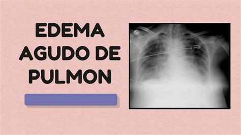 Edema Agudo de Pulmón MIz uDocz