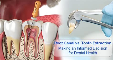 Root Canal Vs Tooth Extraction Making An Informed Decision