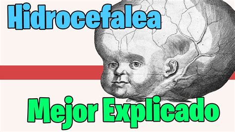 HIDROCEFALIA Que Es CAUSAS SINTOMAS DIAGNOSTICO Y TRATAMIENTO
