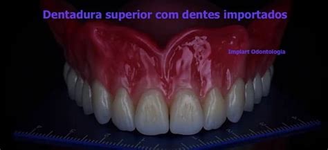 dentes importados para prótese dentária ImplArt