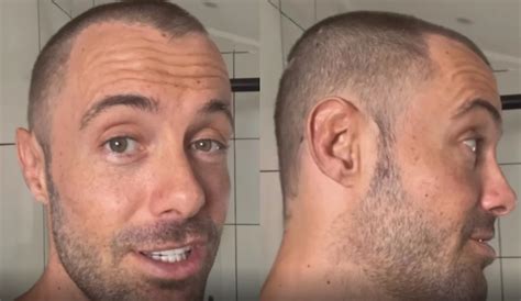 Em Recupera O Kayky Brito Mostra Cicatriz Na Cabe A