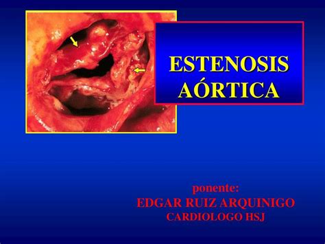 Estenosis Aortica Ahmed Casana UDocz