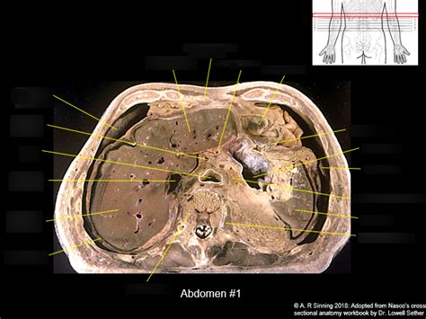 Abdomen Cross Section 1 Diagram Quizlet