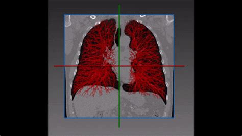 automated lung vasculature segmentation with deep learning