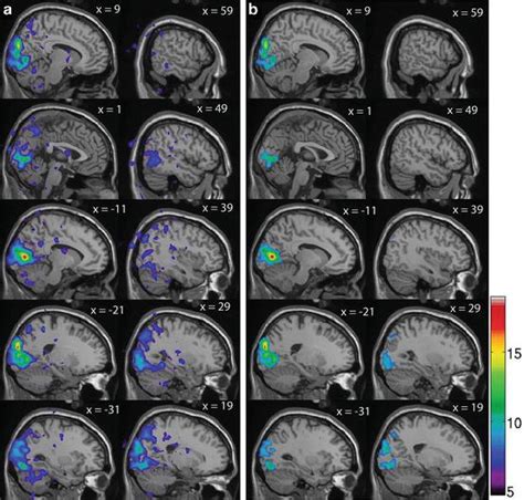 first level fmri data analysis for activation detection radiology key