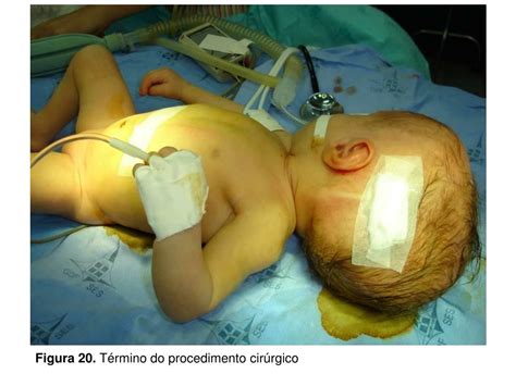 PPT ESTUDO DE CASO DERIVAÇÃO VENTRÍCULO PERITONEAL PowerPoint