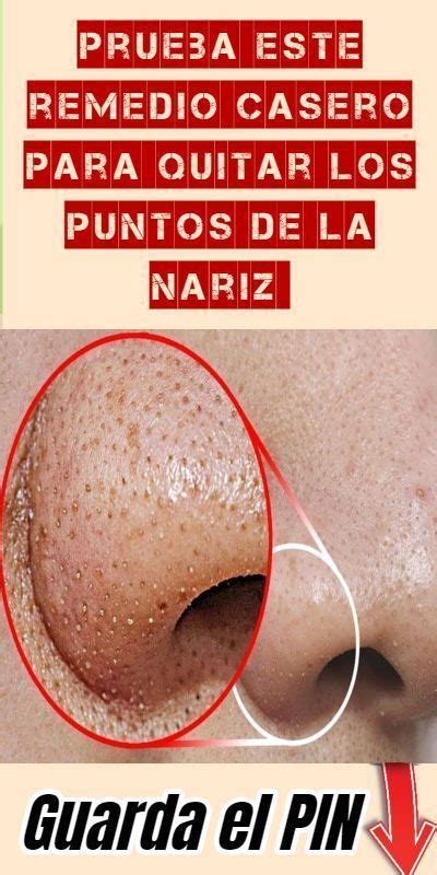 Remedios Naturales Para Eliminar Las Verrugas Genitales Artofit