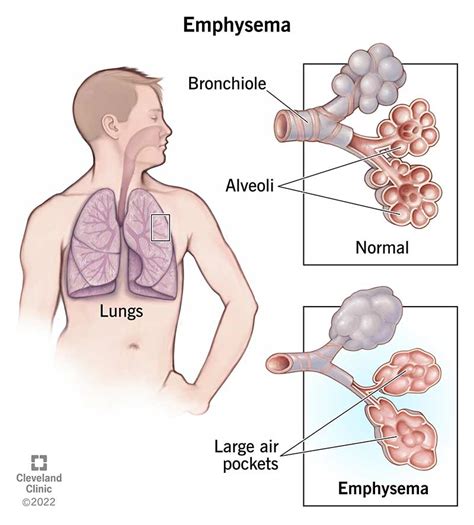 Understanding Emphysema Causes Symptoms And Treatment