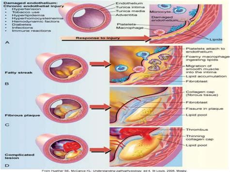 Atherosclerosis Pathophysiology Ppt