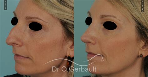 Rhinoplastie ultrasonique avant après la prise de photos