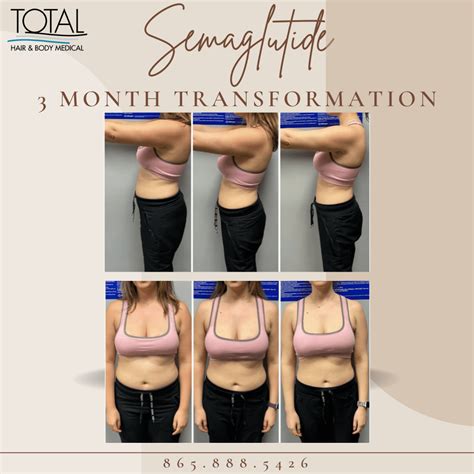 Great Semaglutide Ozempic Weight Loss Before And After Pictures Learn