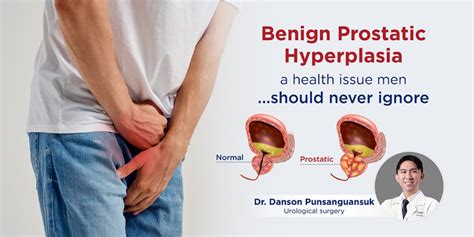 Benign Prostatic Hyperplasiaa Health Issue Men Should Never Ignore