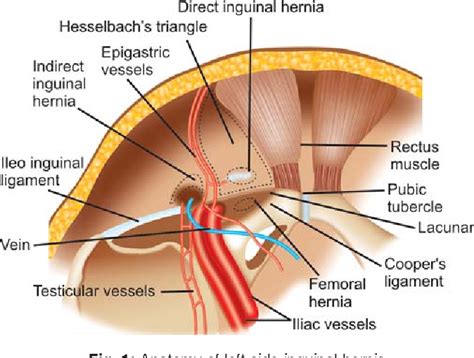 Laparoscopic Inguinal Hernia Anatomy