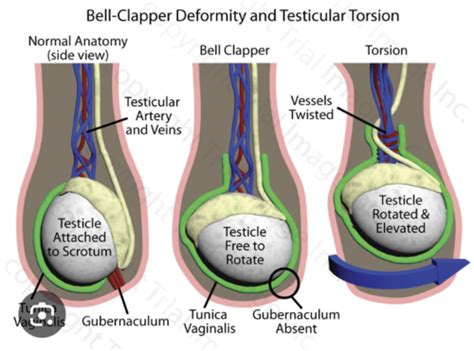 Testicular Torsions Flashcards Quizlet