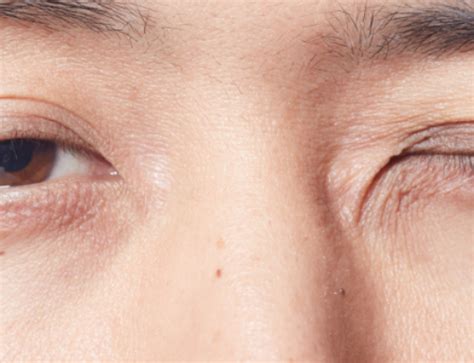 Qué es el edema palpebral Causas síntomas y tratamientos Daniel Perera