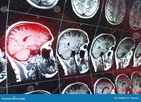 Exploración De Resonancia Magnética Del Cerebro Con El Cráneo