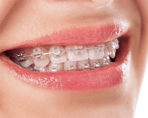 Antalya Ortodontist Diş Estetiği Telsiz Ortodonti Invisalign