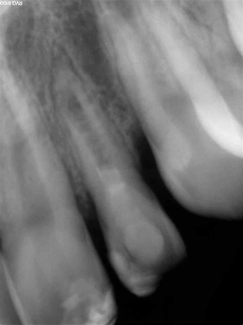 Revascularizaciones Nina Camborda Endodoncista