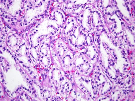 Pathology Outlines Clear Cell Papillary Renal Cell Tumor