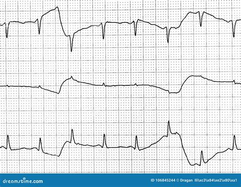 Prueba Del Electrocardiograma Que Muestra La Actividad Eléctrica Del