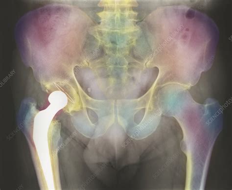 Hip Replacement X Ray Stock Image M600 0230 Science Photo Library