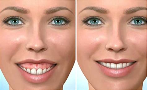 Gummy Smile Correction Orthodontist Chandler AZ Braces 85226 85248