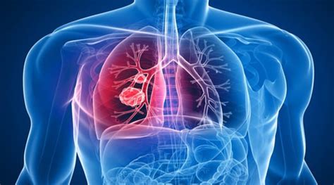 Cie 10 Tromboembolismo Pulmonar Image To U