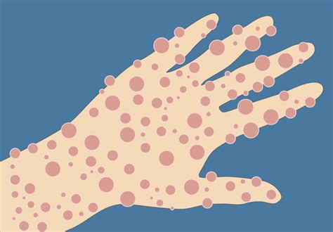 Neurofibromatosis Type 2 NF2