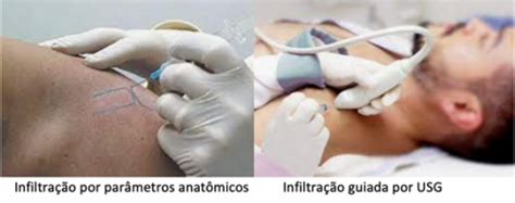 Artrose acrômio clavicular do ombro Dr Artur Utino Membro do grupo