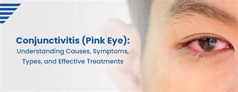 Conjunctivitis Pink Eye Causes Symptoms Treatments Sprint