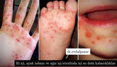 EL AYAK AĞIZ HASTALIĞI Uzm Dr Erdal Pazar