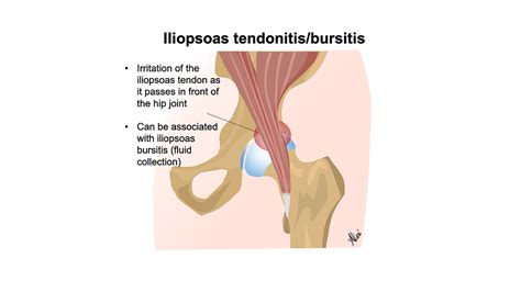 Iliopsoas Tendon Sheath Cortisone Injection Musculoskeletal