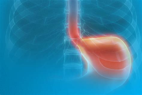 Understanding Barrett S Esophagus Diagnosis And Cancer Risk