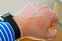 Urticaria qué es tipos síntomas y causas Tua Saúde