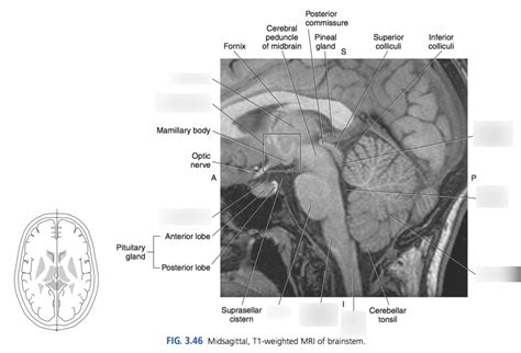 Diagram Of Mid Sagittal MRI Of Brainstem Quizlet