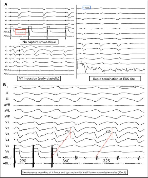 Figure 1 From Challenges And Pitfalls Of Entrainment Mapping Of