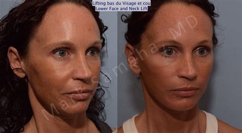 Lifting du visage Cou Facelift Necklift Avant Après Photos