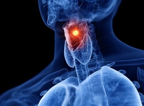 Vocal Cord Paralysis Symptoms Diagnosis And Treatment