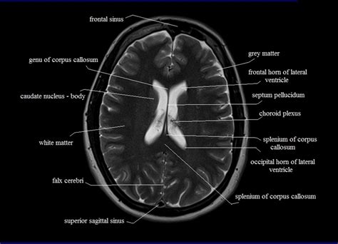 MRI Anatomy Free MRI Axial Brain Anatomy