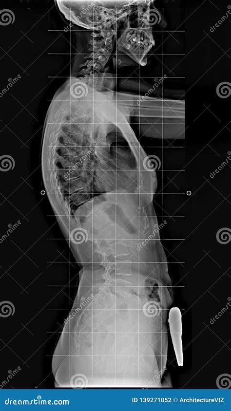 X Ray Of Human Body From Chest To Pelvis Complete Spinal Kyphosis