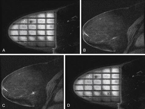 MRI Guided Breast Biopsy Radiology Key