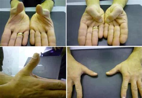 Cómo identificar y tratar las fracturas en el dedo pulgar Consejos de