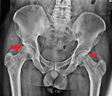 New Technique Of Reverse Bone Grafting With Core Decompression And