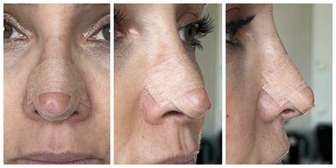 Taping nasal après une rhinoplastie Dr Frédéric LANGE