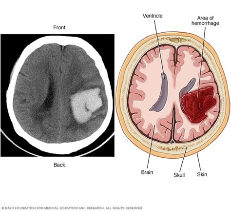 Hemorragia Intracerebral Mayo Clinic
