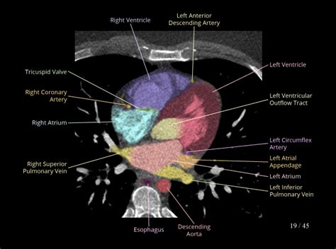 Anatomy Of The Heart And Coronary Arteries Normal Anatomy