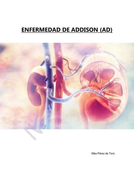 Enfermedad de Addison Alba Pérez uDocz